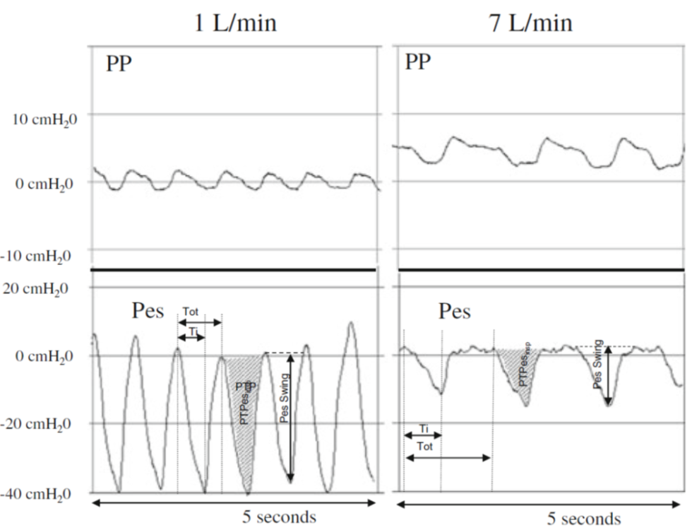 Pressure-Targeted NHF with NAPA - DRW Medical